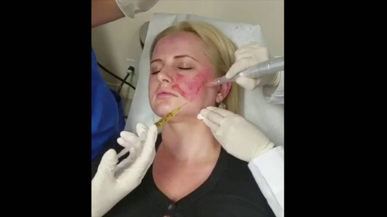 Micro Needling & PRP | The Vampire Facial | Adult & Pediatric ...