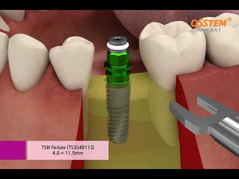 Osstem TSIII - Taper Kit Surgical & Drilling Sequence - YouTube