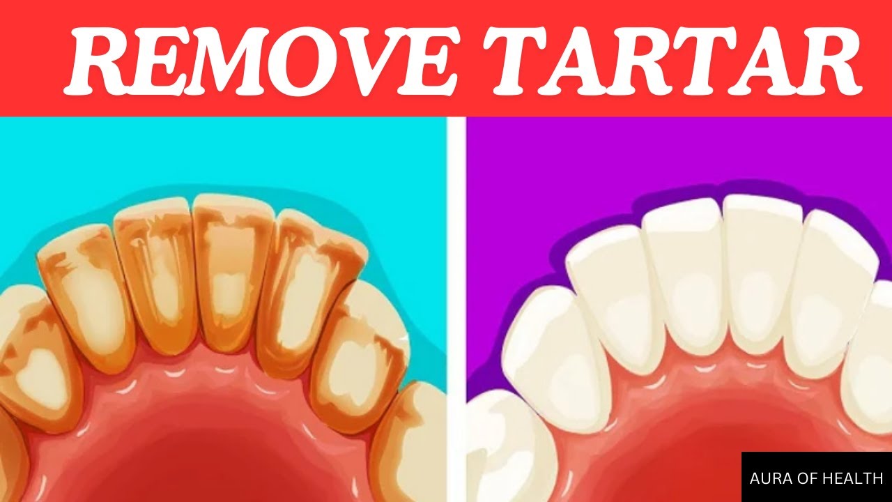 10 NATURAL WAYS to Remove Tartar Build Up (NO Dentist Visit) - YouTube