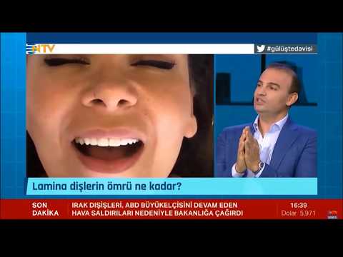 Porselen Laminaların Ömrü Ne Kadardır?