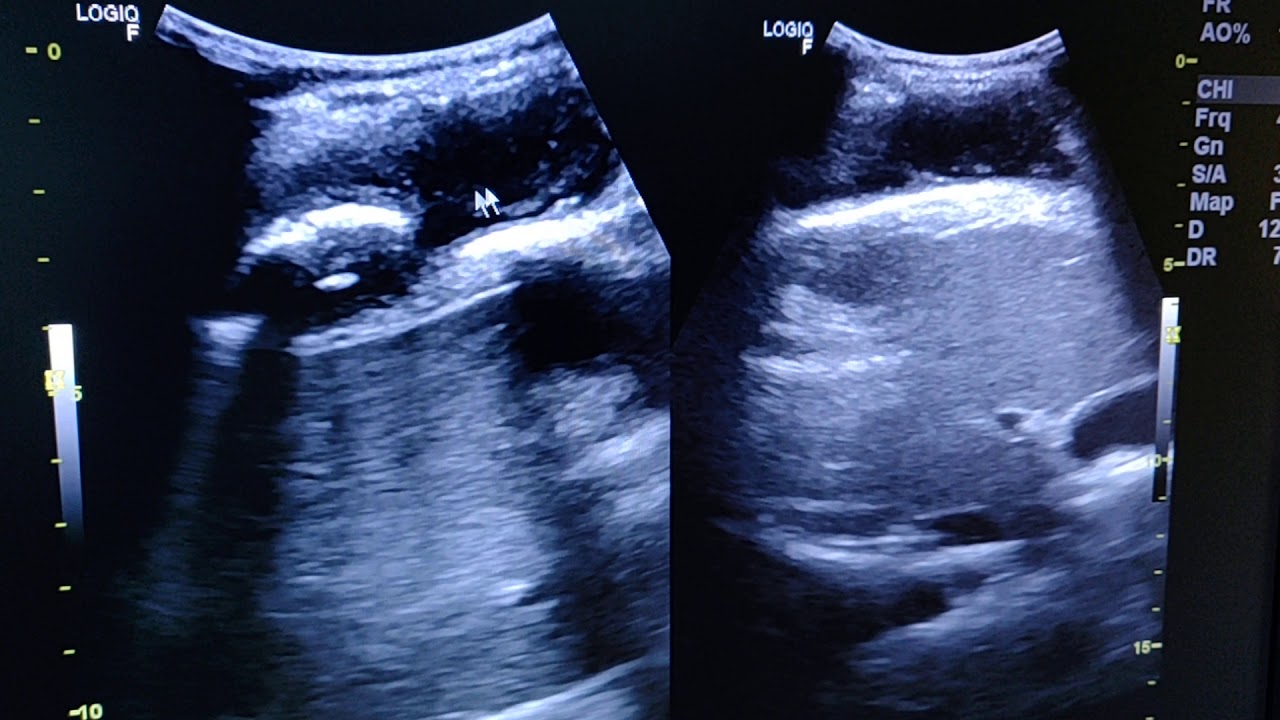 Chest wall Abscess raw(4) - YouTube