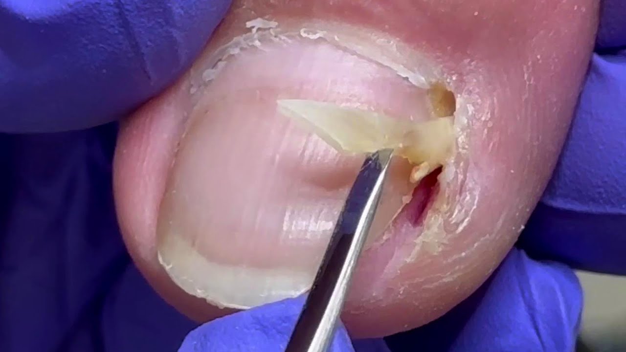 Wearing narrow shoes for a long time, causing the toenails to deform ...