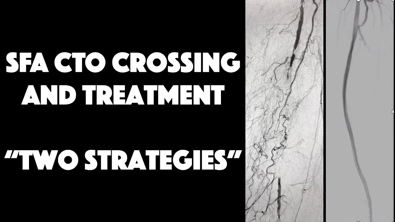 SFA CTO Crossing Technique & 2 Treatment Strategies - YouTube