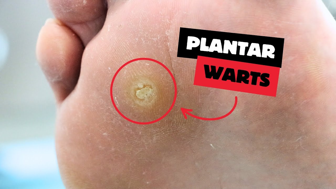 What are Plantar Warts (verruca plantaris) and how do you get rid of ...