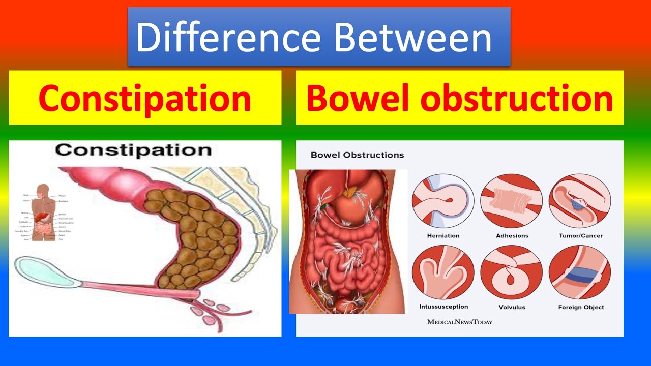 Difference Between Bowel obstruction and Constipation - YouTube