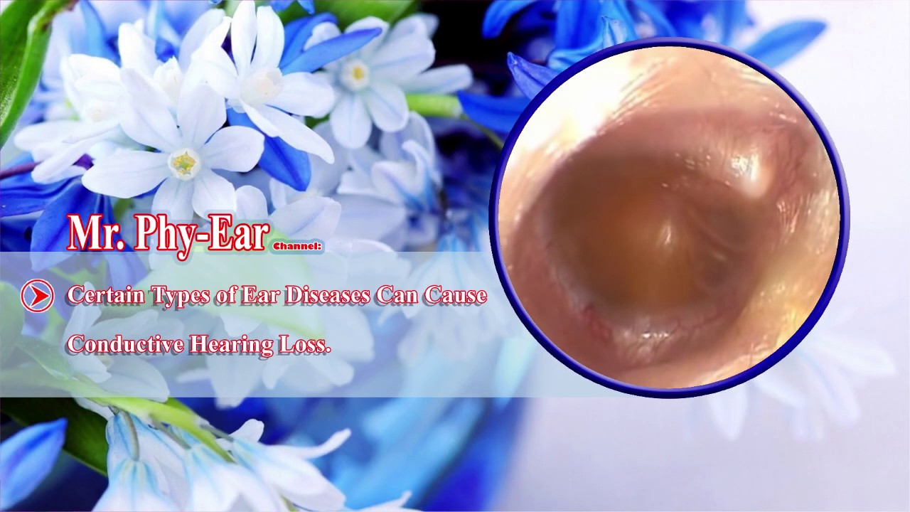 cholesteatoma | tympanosclerosis #14 - YouTube