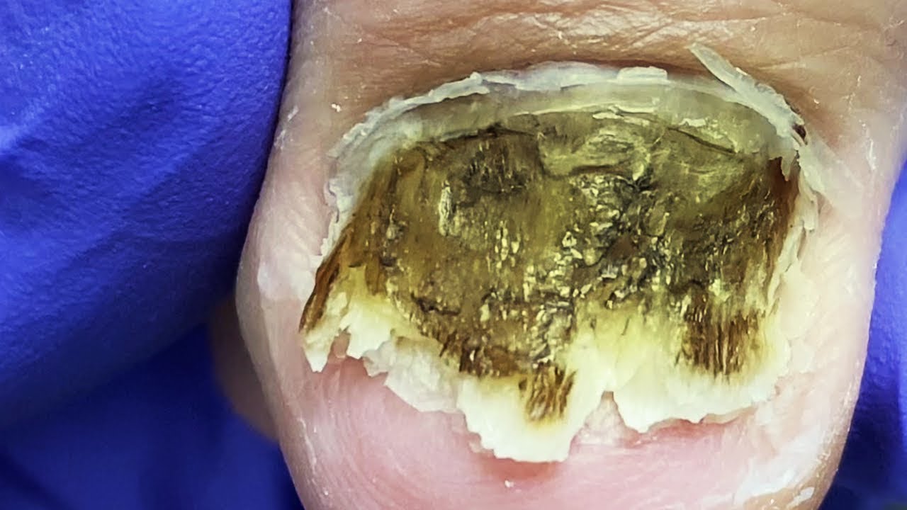 All Nails Go Bad, Professional Pedicure Trim - YouTube