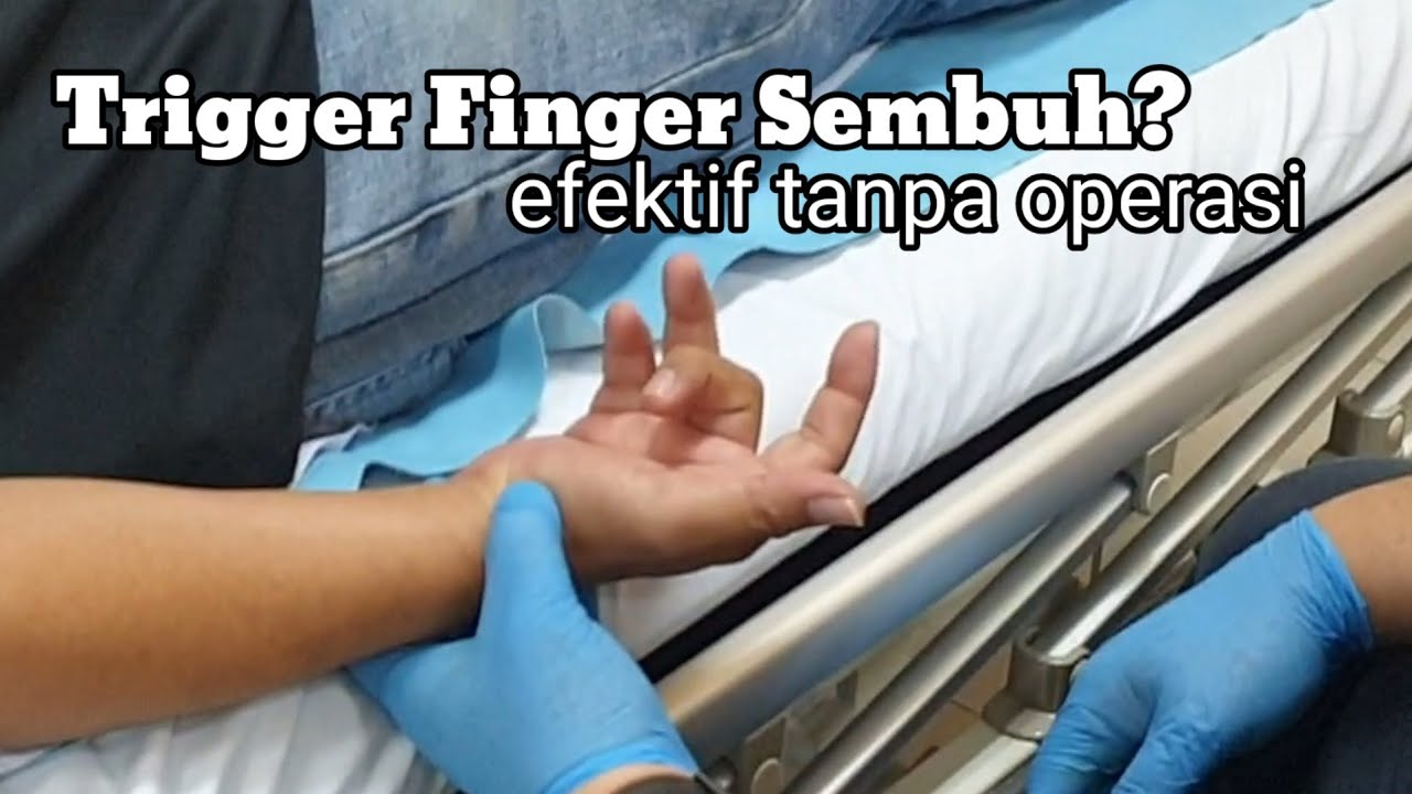 Tenyata ini Terapi Paling Efektif untuk Trigger Finger ☝☝☝ - YouTube