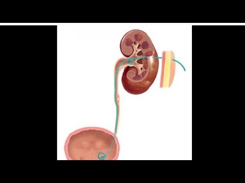 Lap Nephrostent during pyeloplasty by @Pediatric-Urologist - YouTube