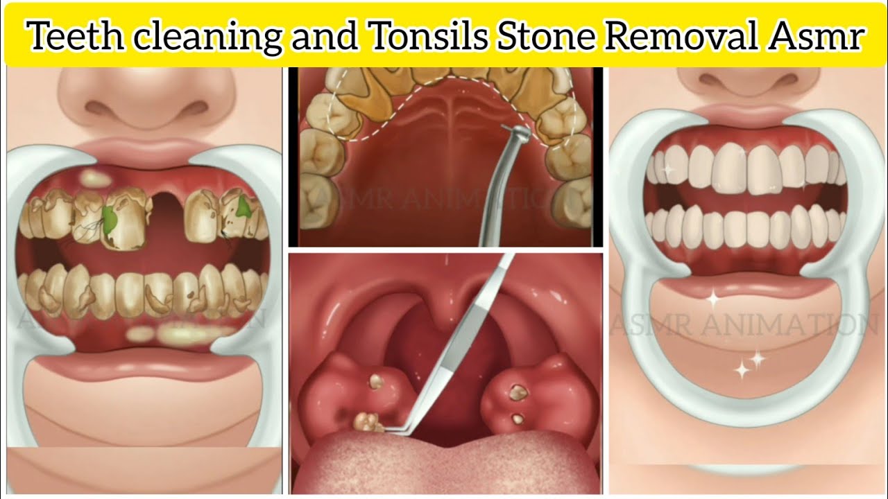 ASMR | Teeth cleaning And Tonsil Stones Remove | - YouTube