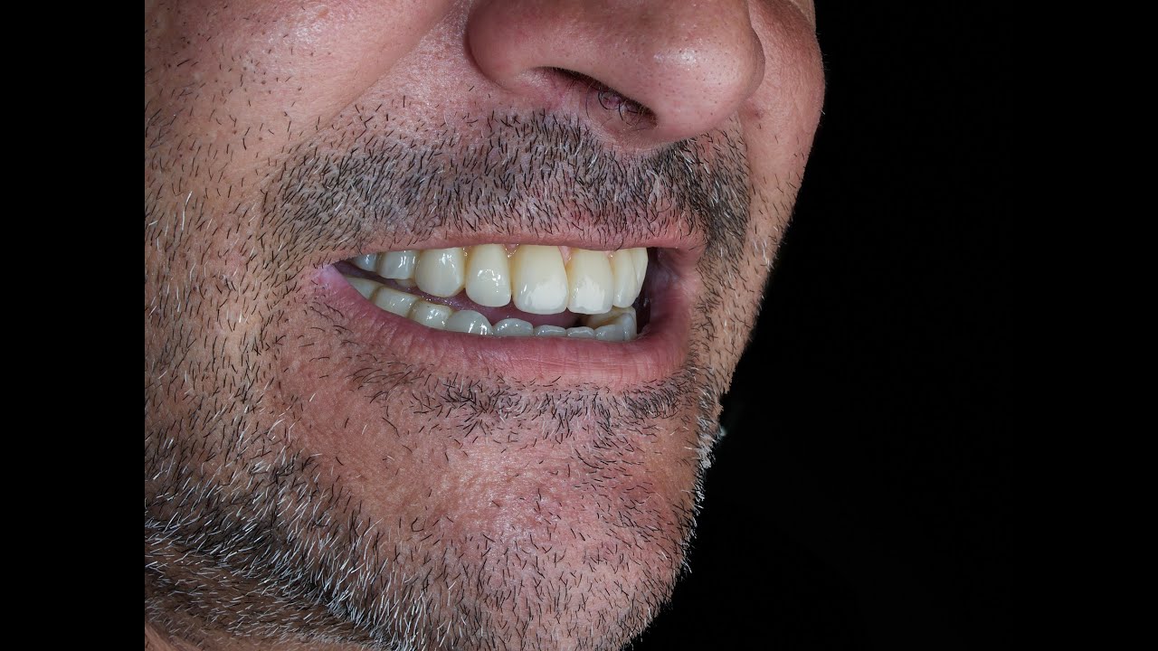 Moving teeth replaced with implants and new fixed teeth in 36 hours ...