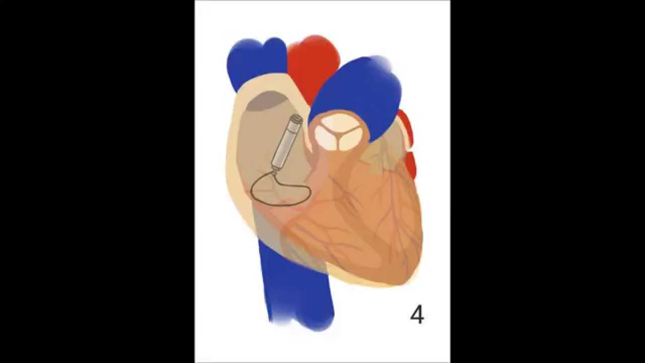Nanostim Anchor Stabilizer for Right Atrium Implants - YouTube