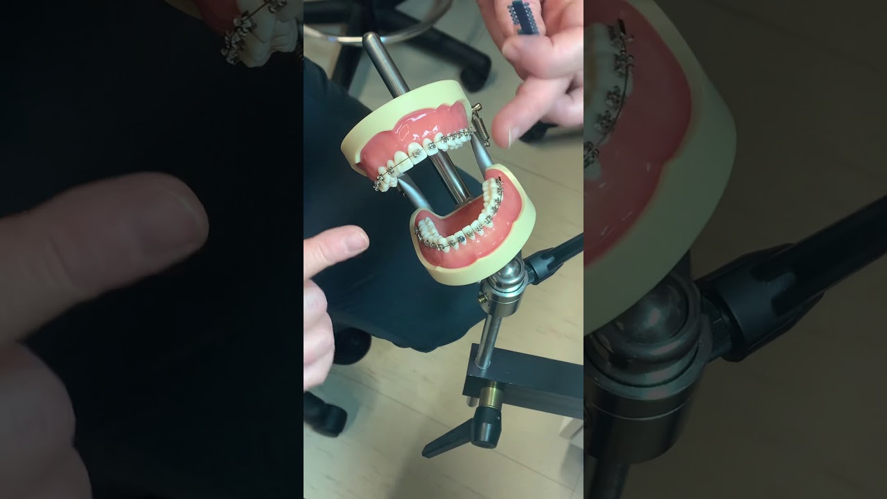 Ligation of Ortho wires - YouTube