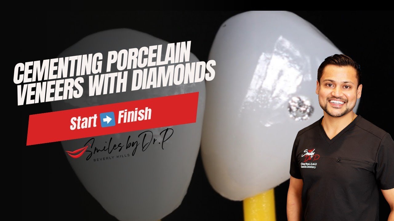 Cementing Diamond Porcelain Veneers | Full Cosmetic Dentistry Process ...