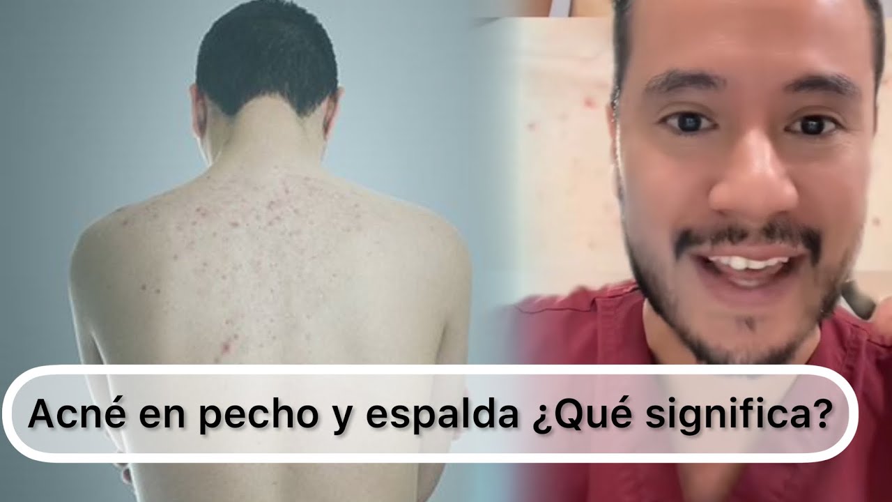 Espinillas (Acné) pecho y espalda ¿Descubramos que te avergüenza ...