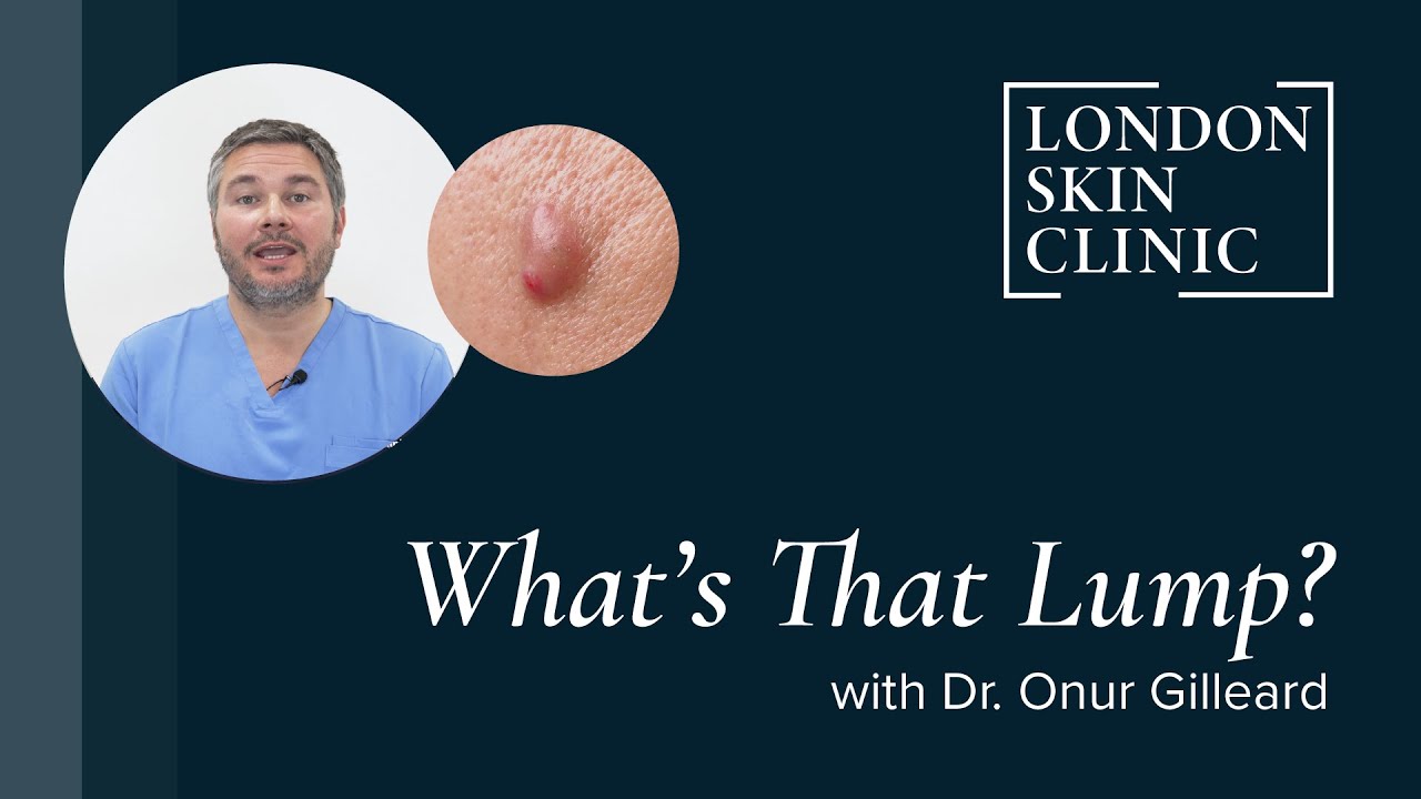What's That Lump? | Understanding Cysts and When to See a Doctor ...
