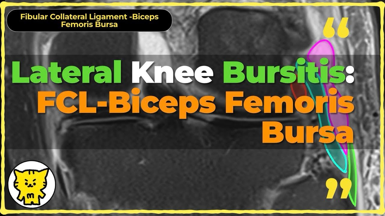 Lateral Knee Bursitis: FCL-Biceps Femoris Bursa - YouTube