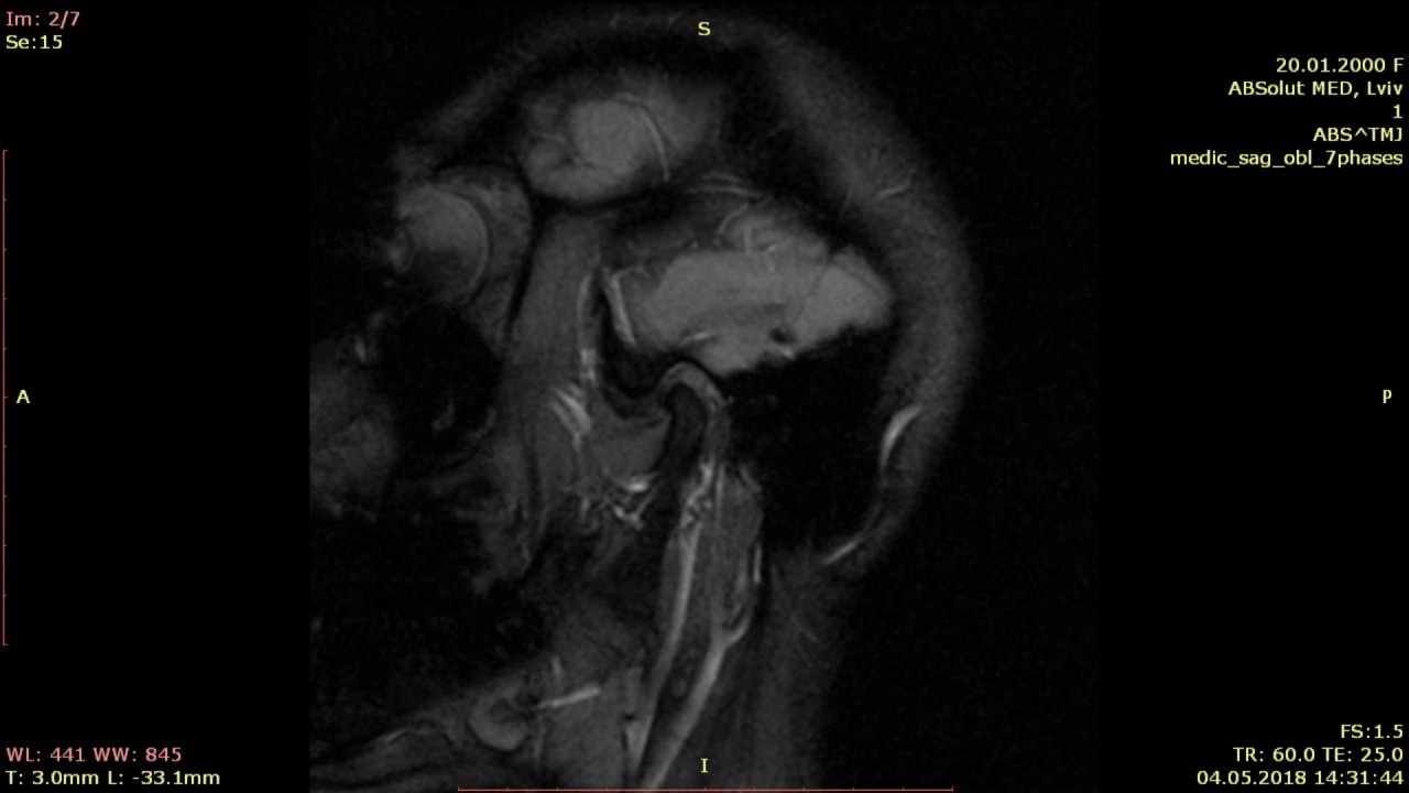 my TMJ MRI CINE MOVIE 8293 - YouTube