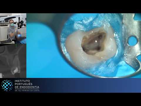 Rtx of 🦷26 with separated file and MB1, MB2 and MB3 ️ Part 3 | CASE202 ...