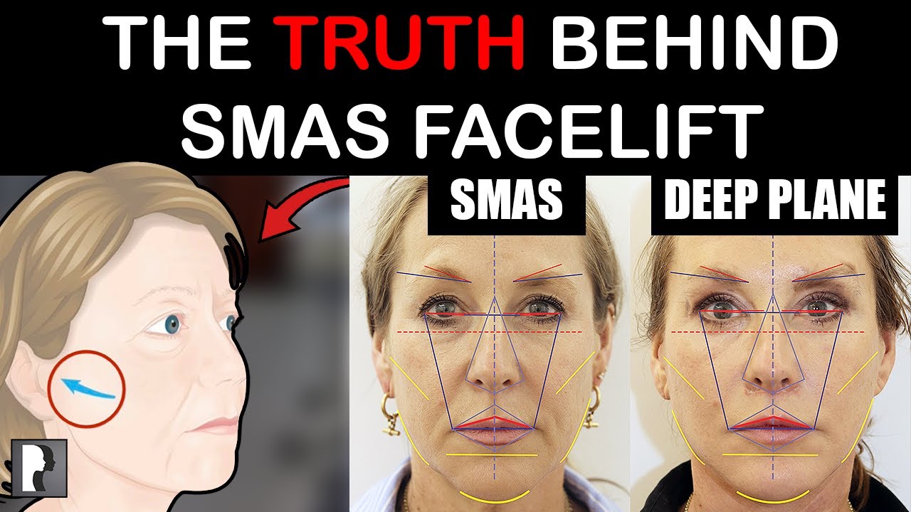 Traditional SMAS Facelift Explained: The Truth Behind This Popular ...