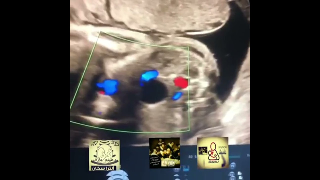 Absent ductus venosus, umbilical vein draining into inferior vena cava ...