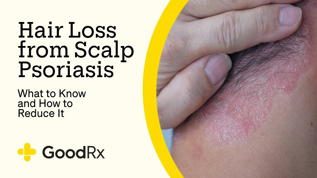 Hair Loss From Psoriasis on the Scalp: What to Know and What Helps ...