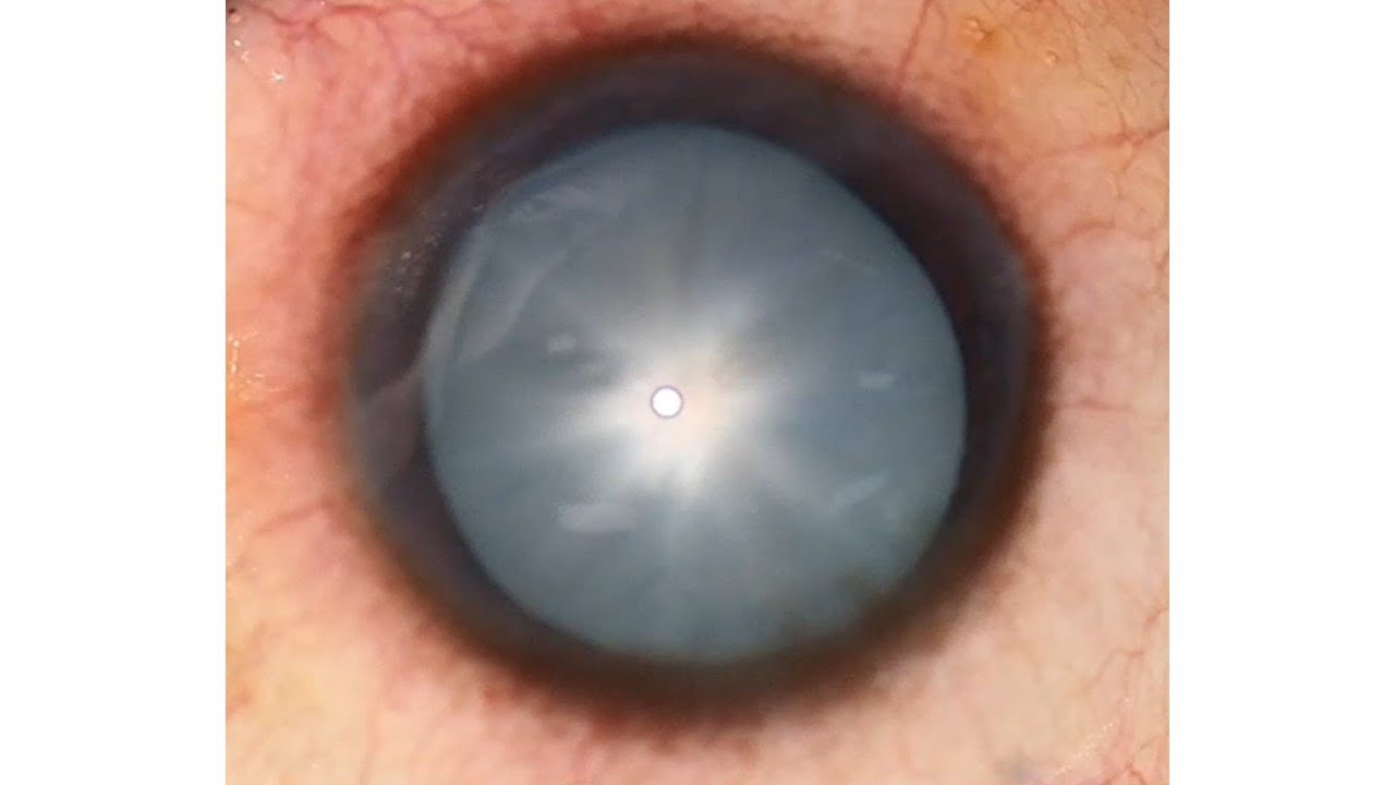 Surprise in toto prolapse of intumescent lens - YouTube