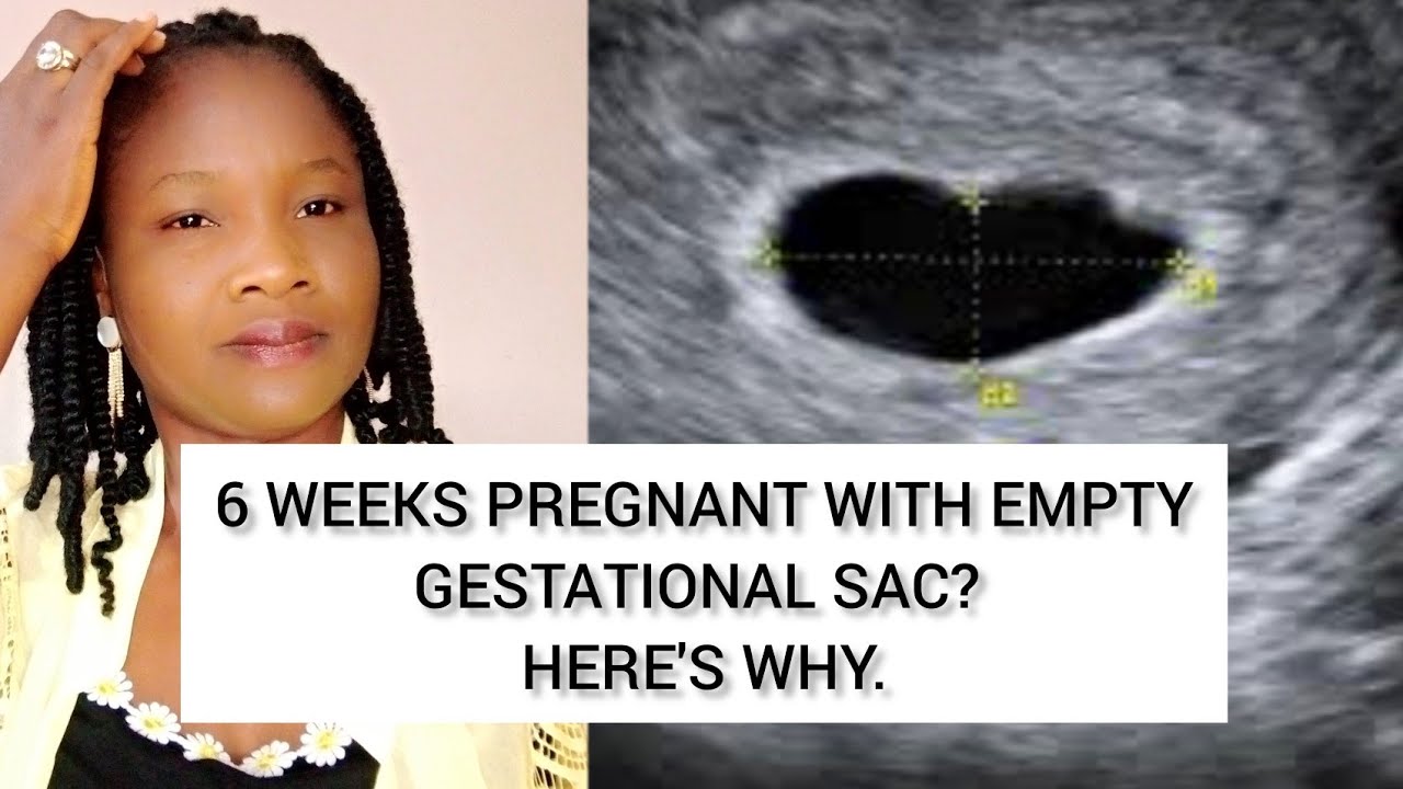 Empty Gestational Sac At 6 Weeks| BLIGHTED OVUM?| How to prevent ...