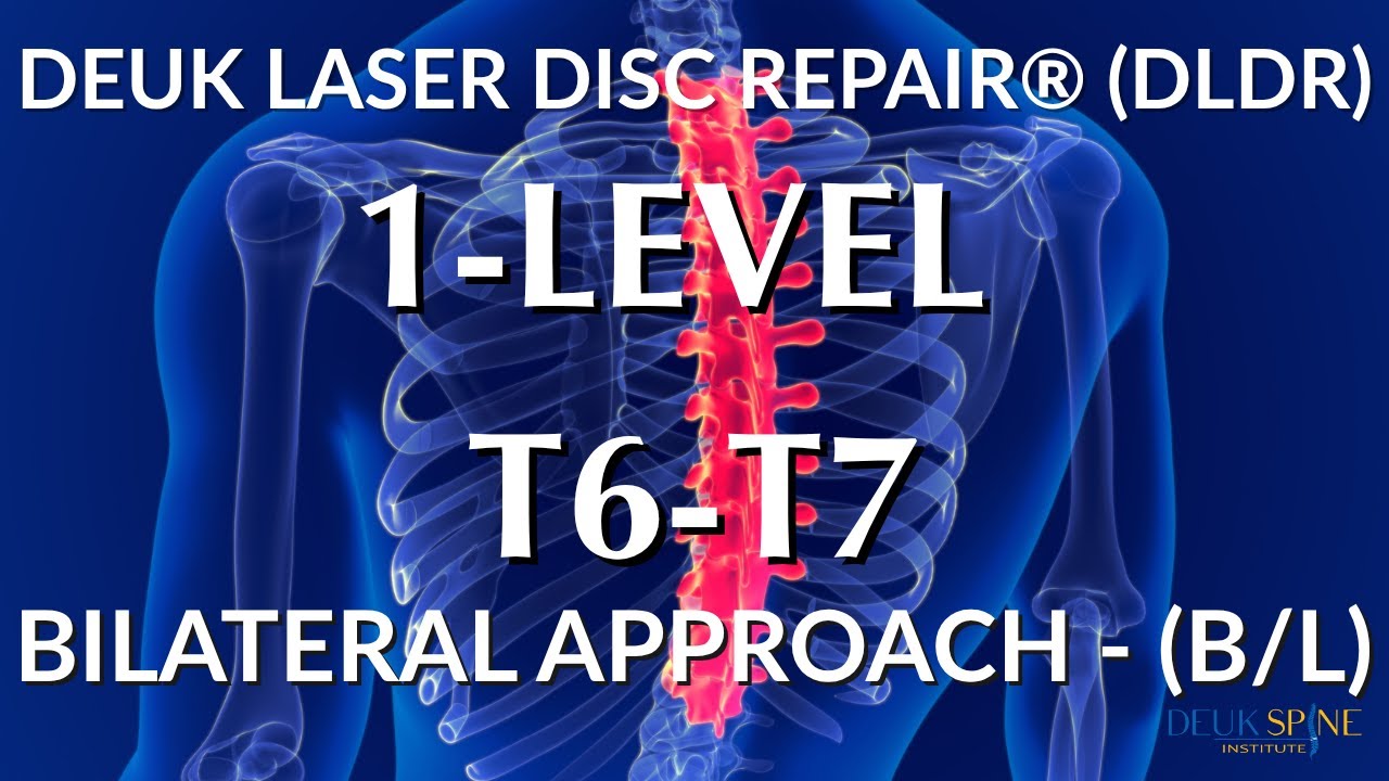 THORACIC DISC T6-T7 - LIVE - Laser Spine Surgery - YouTube