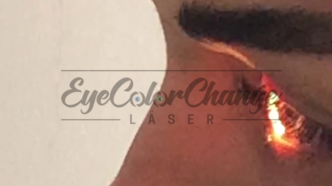 Eye Color Change with Premium Laser - During The Treatment - YouTube