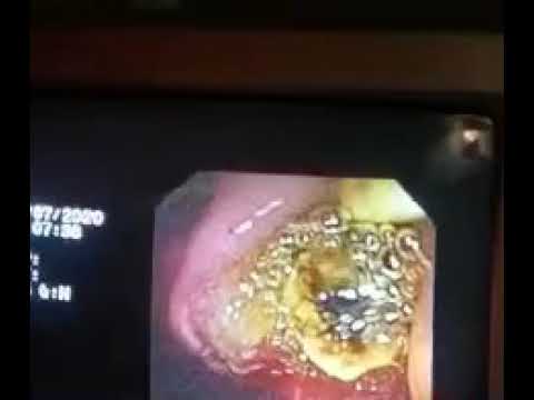 CBD stone extraction using the balloon - YouTube