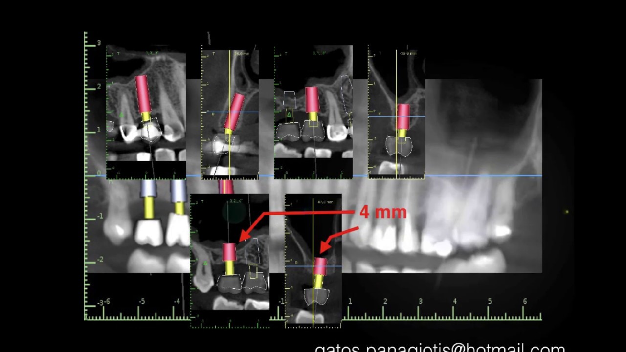 Internal Sinus Lift using Versah Burs - YouTube