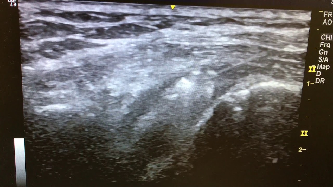 Barbotage procedure - YouTube