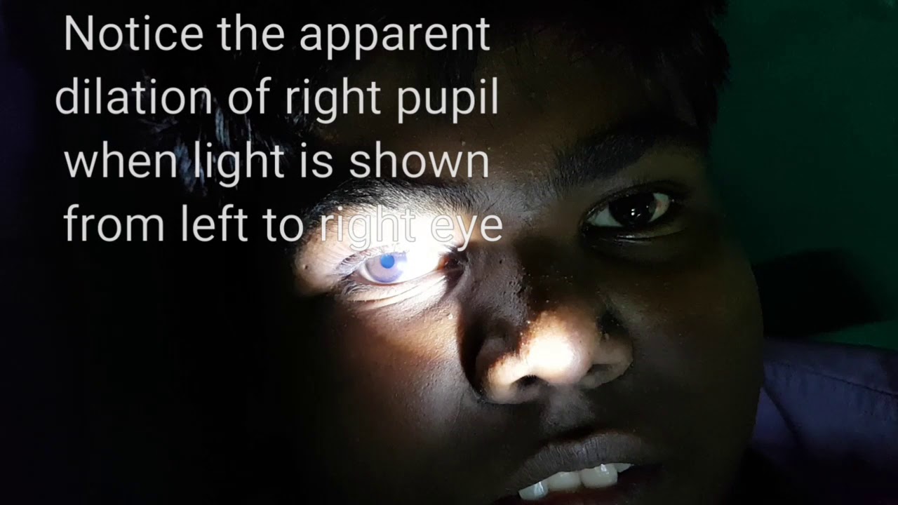 RAPD,Relative afferent pupillary defect,MARCUS GUNN PUPIL - YouTube