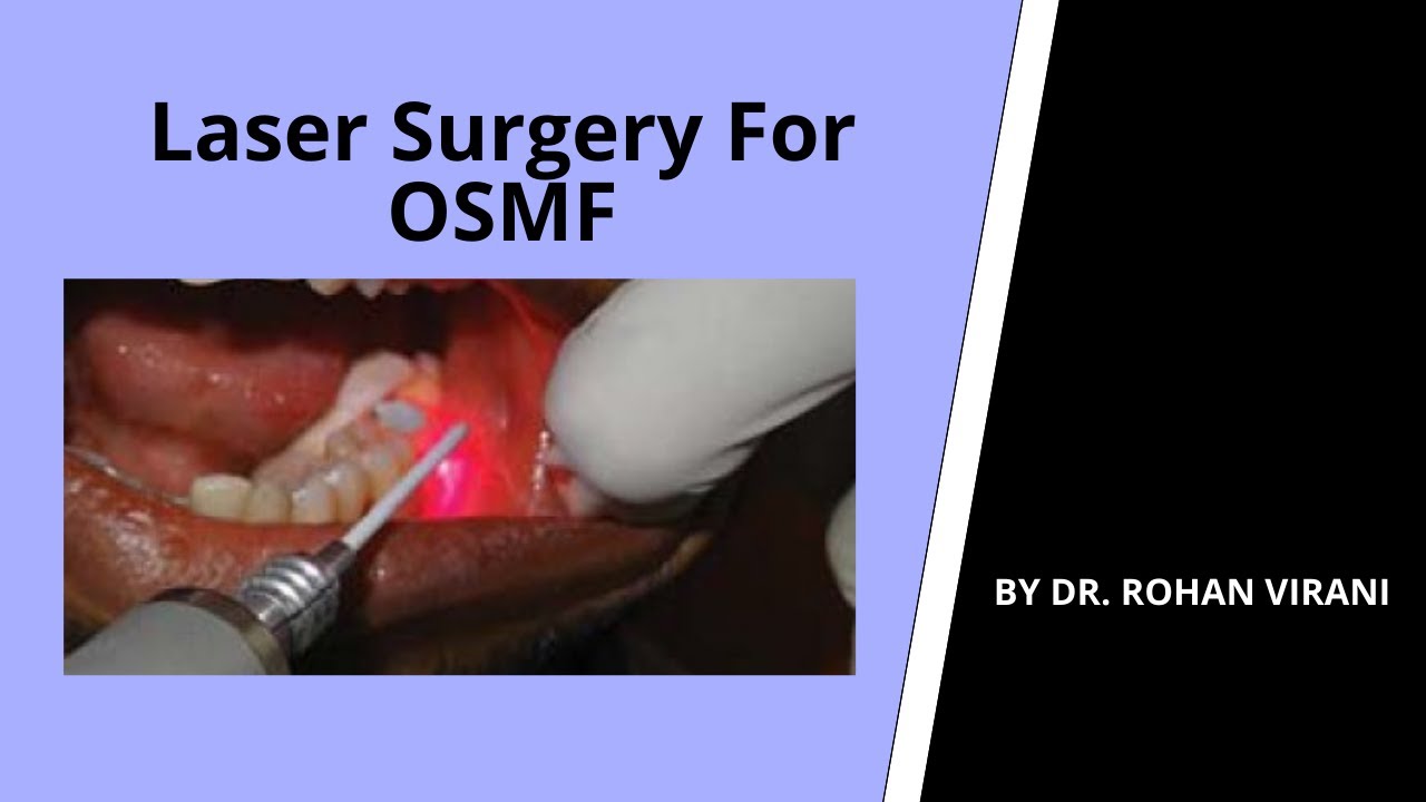🆕laser Surgery For Osmf Laser In Dentistry Must See! - YouTube