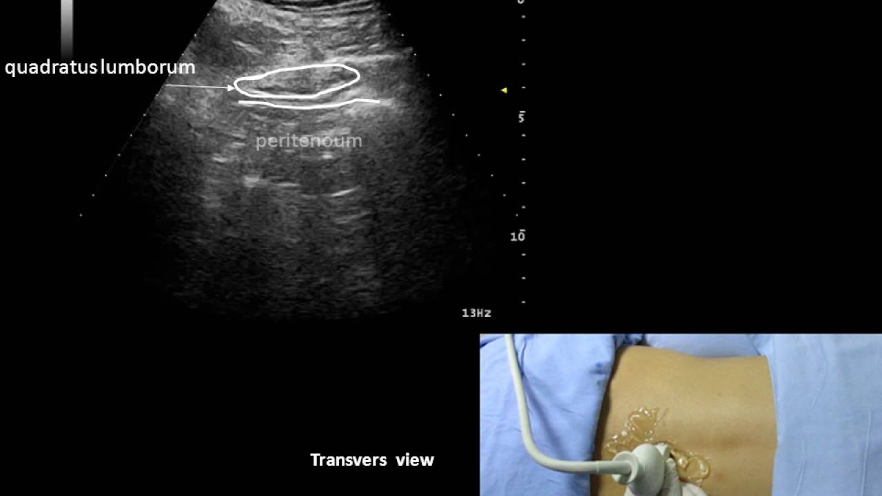 Quadratus Lumborum Trigger Points