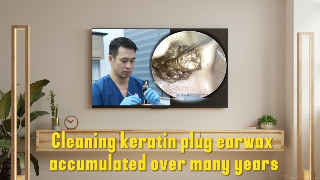 Cleaning keratin plug earwax accumulated over many | ear cleaning ...