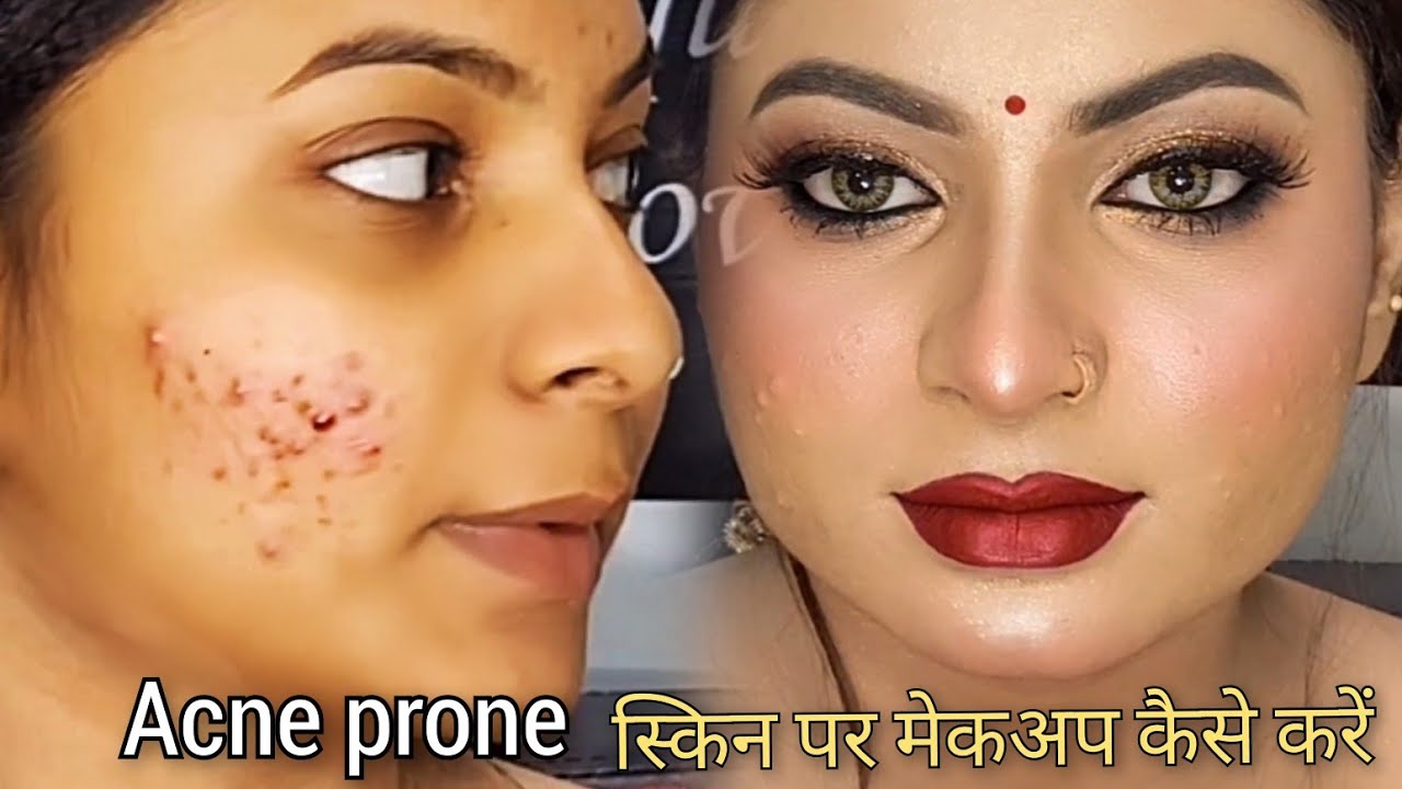 "Acne Prone Skin पर Makeup कैसे करें | Step-by-Step Makeup Tutorial for Flawless Skin" - YouTube
