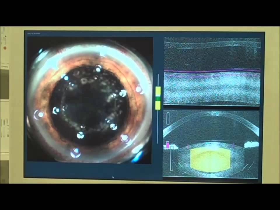 Dr Robert Weinstock speaks about Bladeless Cataract Eye Surgery - YouTube