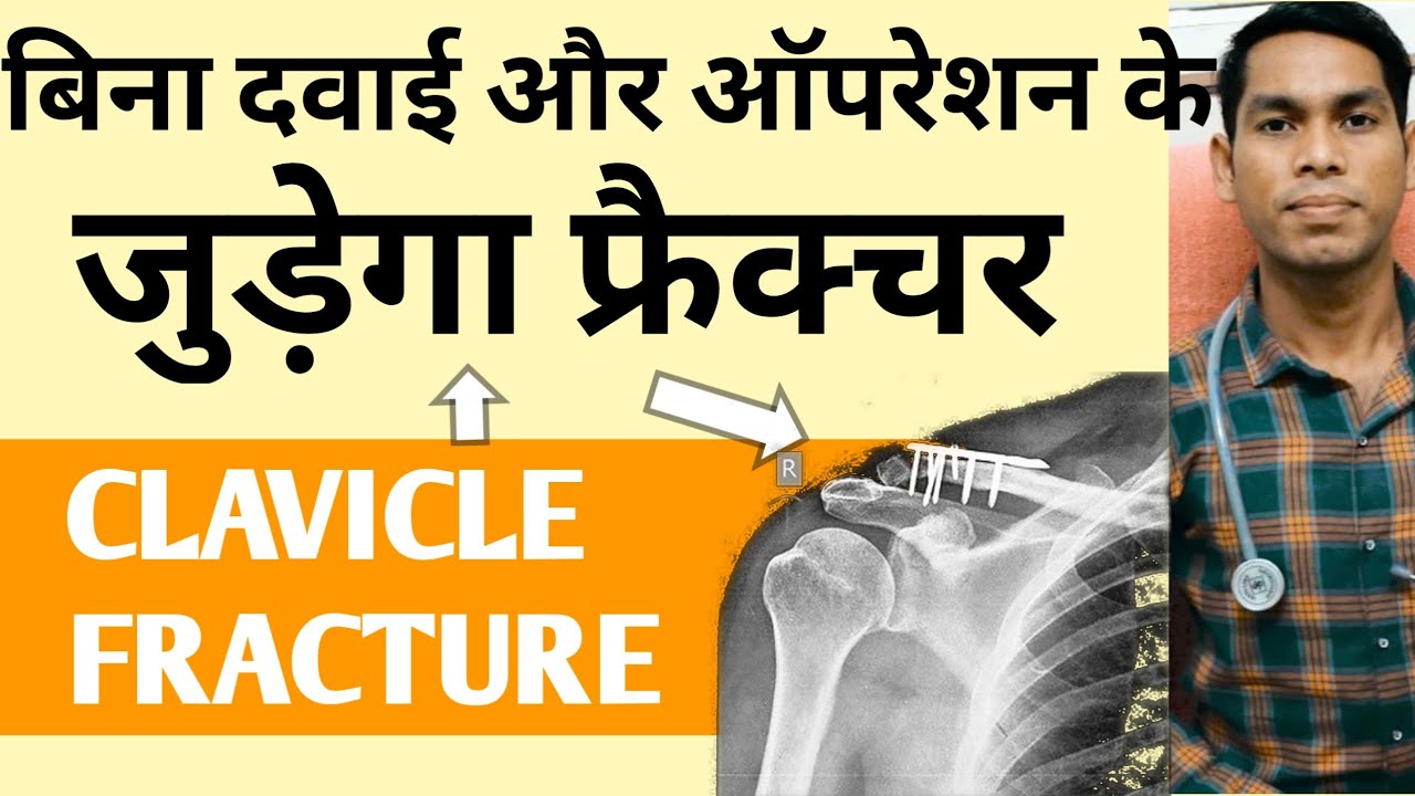 Clavicle Bone Fracture Treatment In Hindi