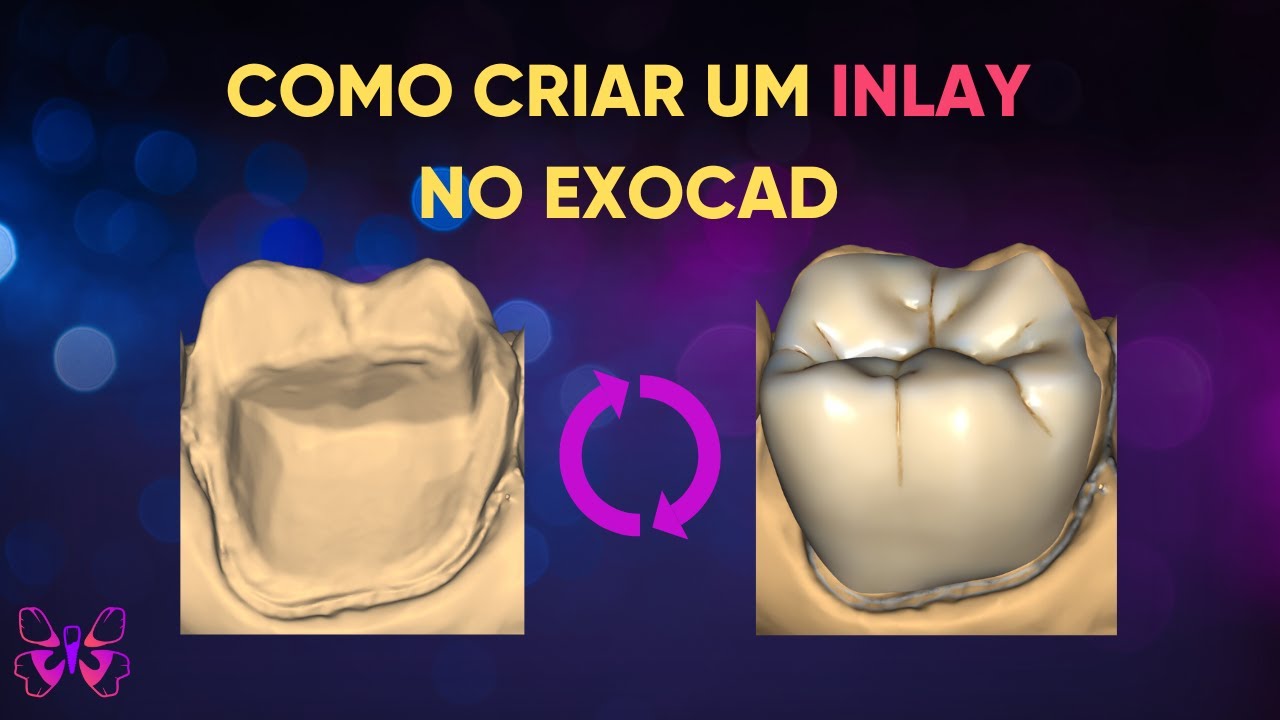Como criar um Inlay no Exocad / How to Create an Inlay in Exocad - YouTube