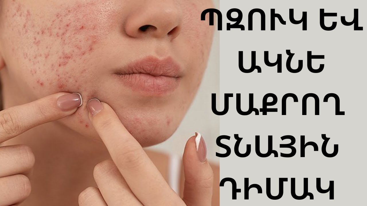 ՅՈՒՂՈՏ մաշկի ԱԿՆԵՅԻ ու ԴԵՄՈԴԵՔՍԻ շատ արդյունավետ դիմակ տնային խնամքի