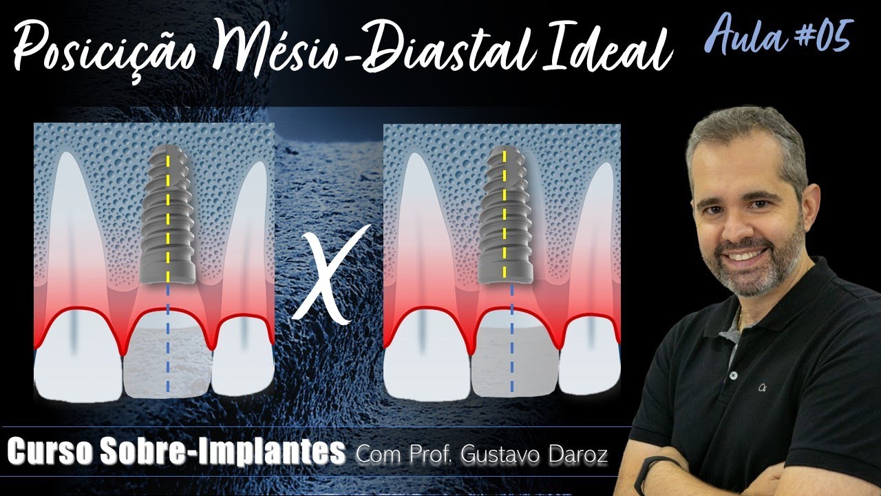 Posição MÉSIO-DISTAL ideal do Implante - Curso SOBRE-IMPLANTES - Aula ...