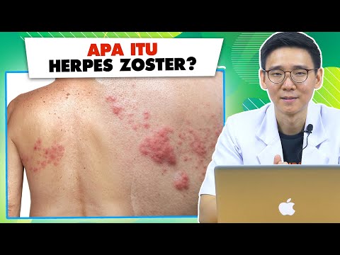 Apa Itu Herpes Zoster Atau Cacar Api?