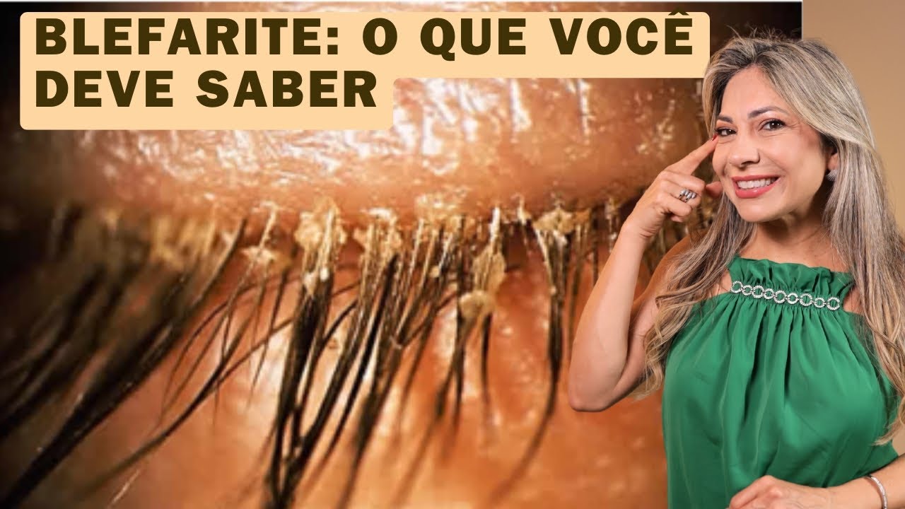Blefarite: O Que É e Como Tratar? - YouTube