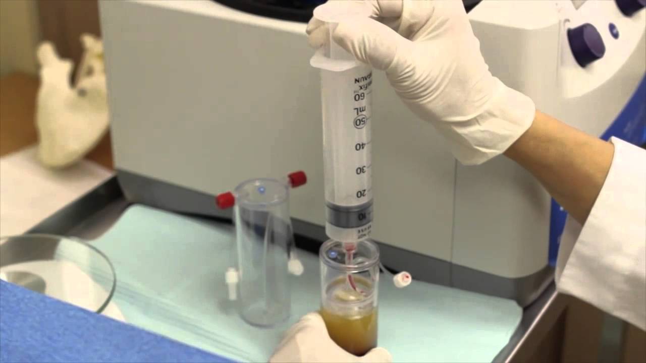 Platelet Rich Plasma Injection - YouTube