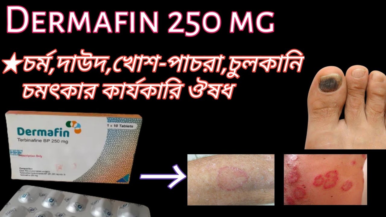 Dermafin 250 চর্মরোগ,দাউদ,প্রচন্ড চুলকানি সহ যেকোনো ছত্রাক জনিত সংক্রমণ ...