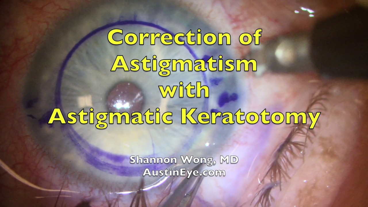 Astigmatic Keratotomy (AK). How we do it. Shannon Wong, MD - YouTube