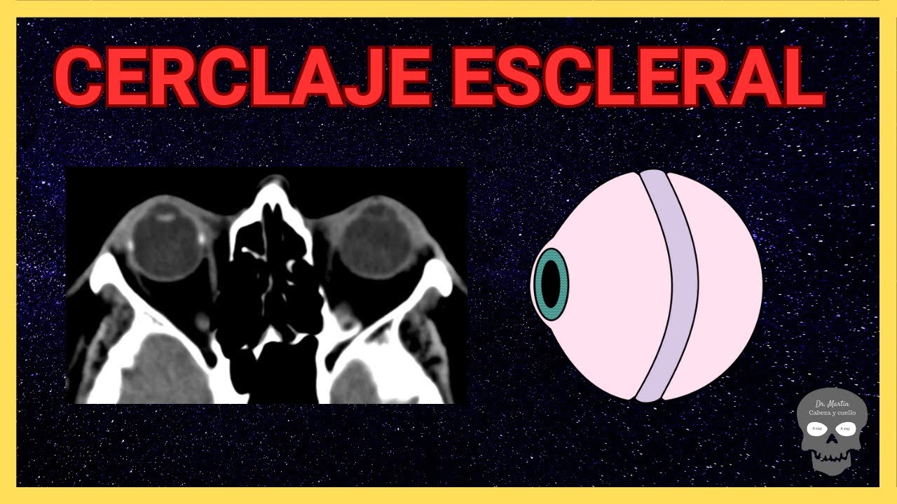 🩻 Cerclaje escleral en tomografía: hallazgos radiológicos esenciales 👁️ ...
