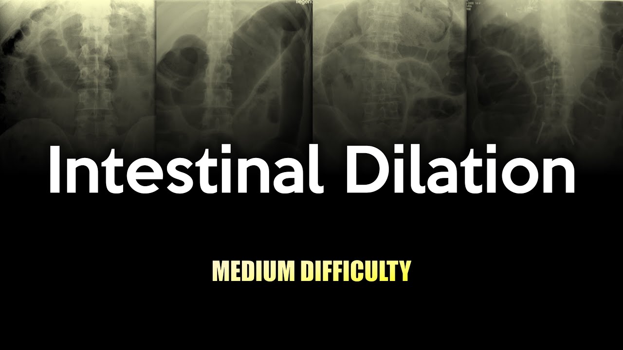 Intestinal Dilatation: Abdominal X-ray Quiz - YouTube
